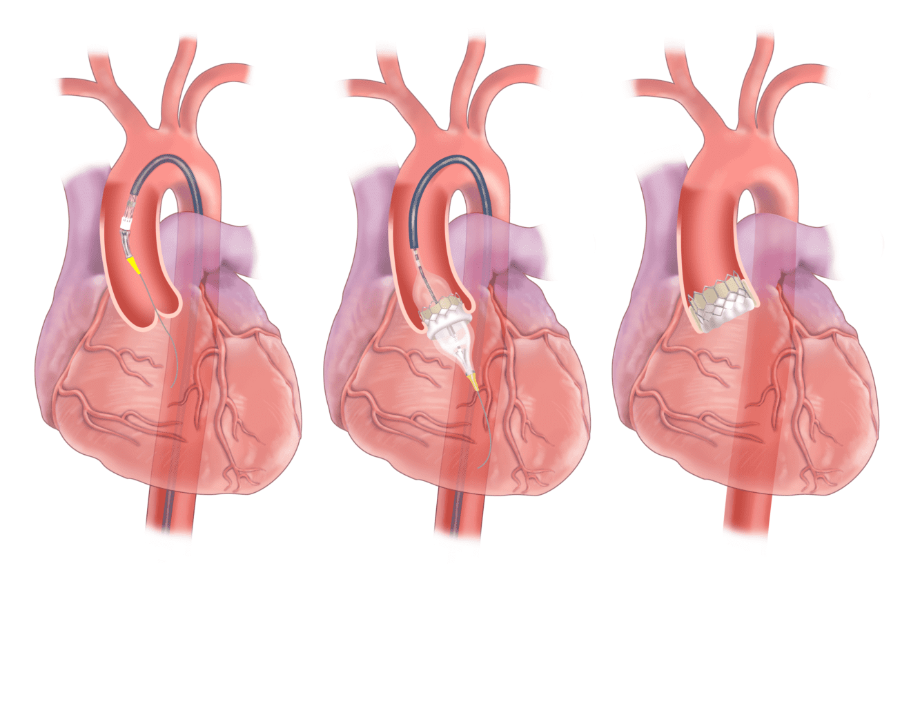 In a first, Hybrid TAVR saves life in a case of twisted aorta and ...
